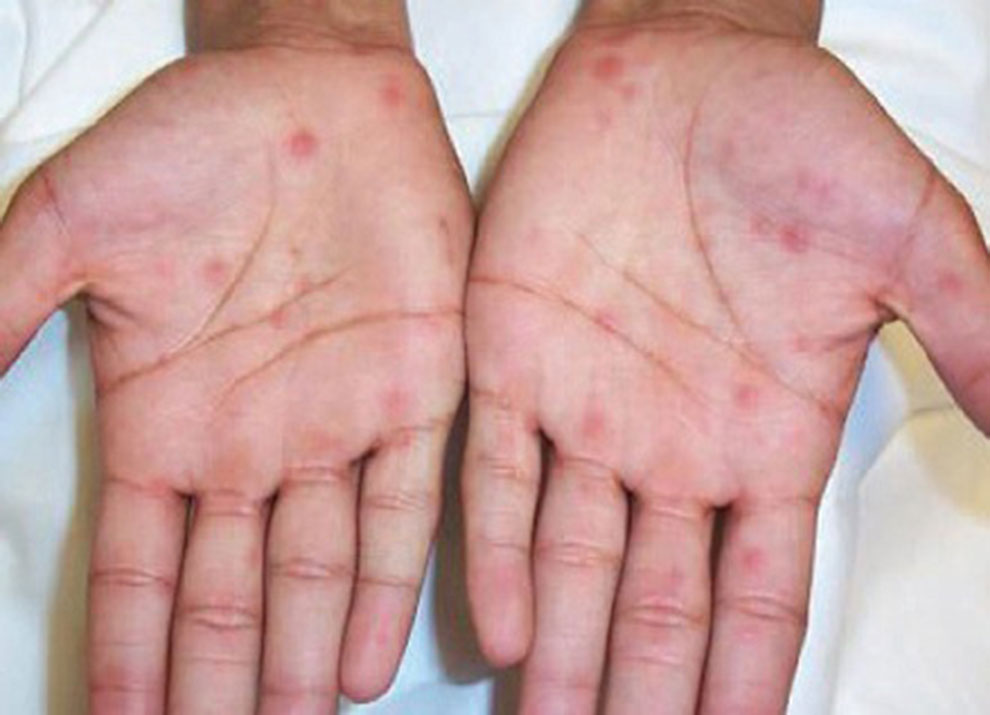 The Phnom Penh Post | Monkeypox advisory issued as Kingdom remains case ...